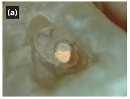 ENDOCEM MTA: Next Generation MTA Material