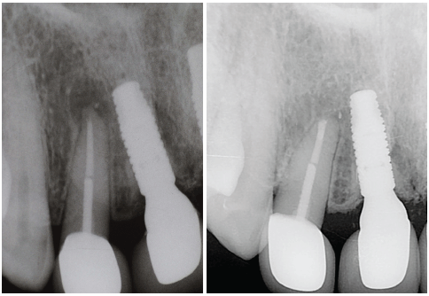ENDOCEM MTA: Next Generation MTA Material
