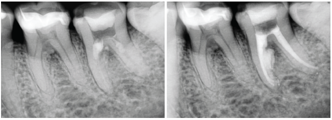 ENDOCEM MTA: Next Generation MTA Material