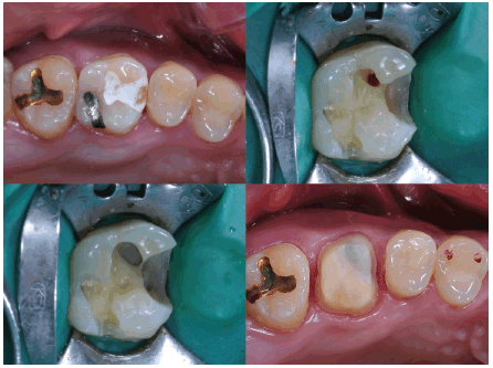 ENDOCEM MTA: Next Generation MTA Material
