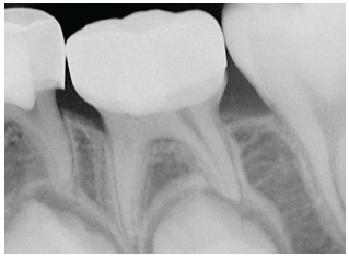 ENDOCEM MTA: Next Generation MTA Material