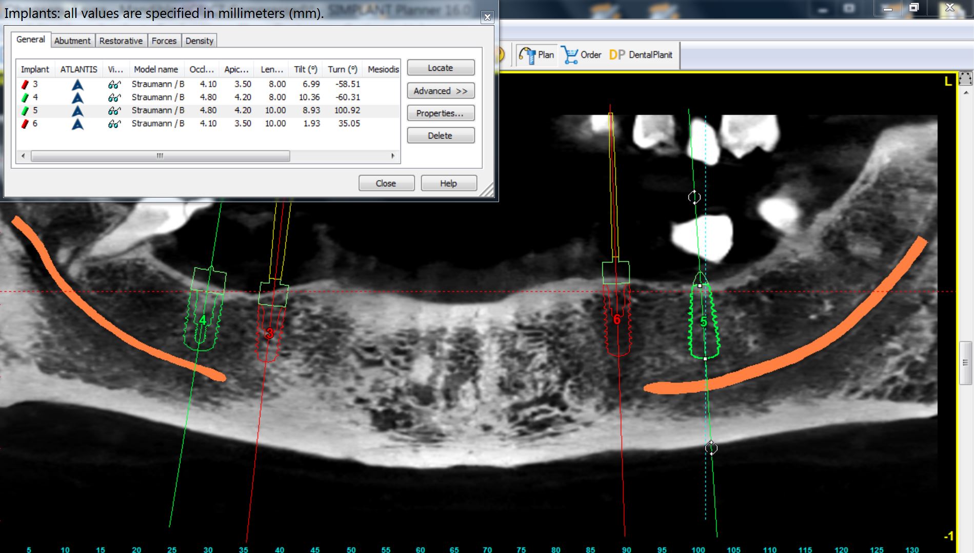 Advice for Straumann Bone Level Implants in posterior mandible?