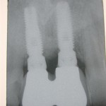 Case Report: Removing Implants with the Neo Fixture Remover Kit