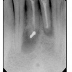 Sponsored Case: Extraction Site with Synoss Putty and MatrixDerm