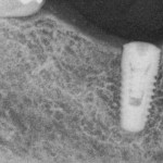 How to salvage angular bone defect around implant?