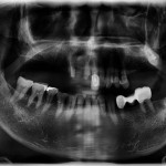 Canine-to-Canine Implanted supported Fixed partial Denture?