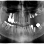 3 implants in his maxillary left posterior maxilla: Implant type?