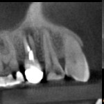 Vertical fracture in upper right second premolar associated with bony ...