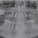 Restoration of angulated implants in the maxilla?
