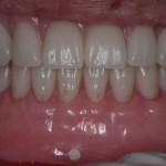 Extraction, Ridge Reduction and Immediate full lower denture