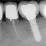 Opening interproximal spaces between implants: why?