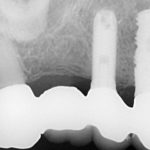 Is it correct to splint implant with devitalized teeth?
