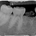 Retained deciduous tooth: can I place an implant?