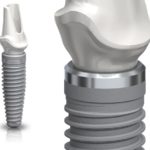 Nobel Active vs. Nobel Conical Connection?