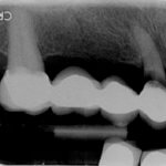 4-Unit Implant Supported Bridge with natural tooth and implant: prognosis?