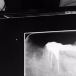 Removal of root tip after extraction?