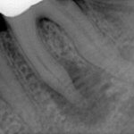 Large radiolucent lesion on lower first molar: immediate implant?