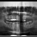 Maxillary molar implants: indirect sinus lift