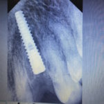 Implant Placed too Deep: Prosthetic Rehabilitation?