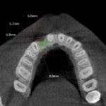 Buccal bone defect in upper lateral incisor region: thoughts?