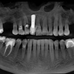 Extraction, Implant Removal, & Grafting: Using PRF, Sticky Bone ...