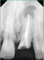 Endo Treated Tooth with an Apical Cyst: Implant Placement?