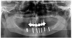Prosthetic options mandibular bridge?